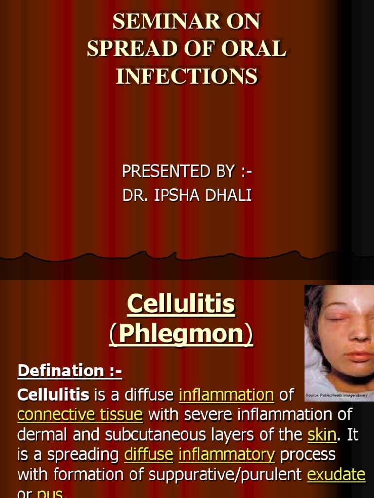 Seminar On Spread of Oral Infections: Presented By:-Dr. Ipsha Dhali ...