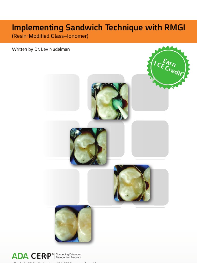 Implementing Sandwich Technique With RMGI: (Resin-Modified Glass ...