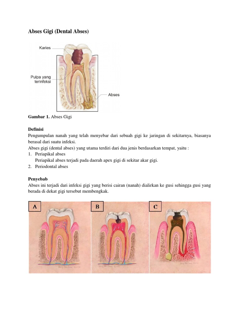 Abses Gigi | PDF