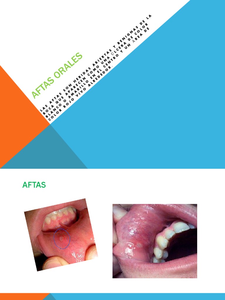 Aftas Orales | PDF