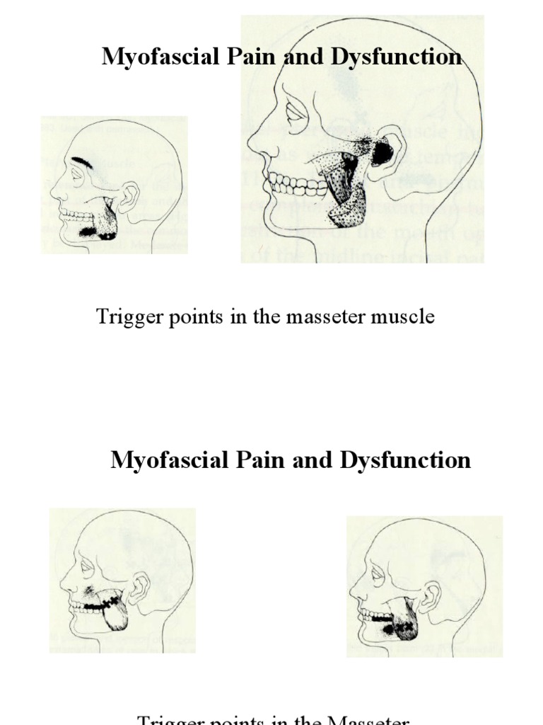 Myofascial Pain and Dysfunction: Trigger Points in The Masseter Muscle ...