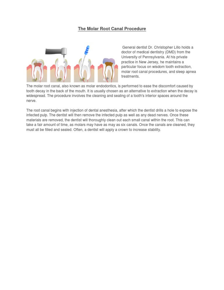 The Molar Root Canal Procedure | PDF | Wellness