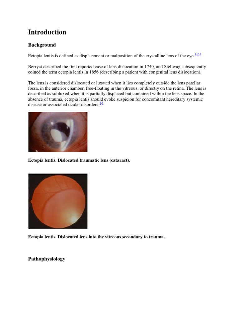 Background: Ectopia Lentis. Dislocated Traumatic Lens (Cataract) | PDF | Glaucoma | Diseases Of ...