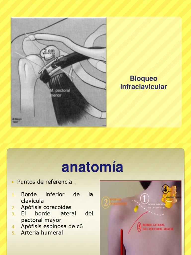 Bloqueo Infraclavicular | PDF