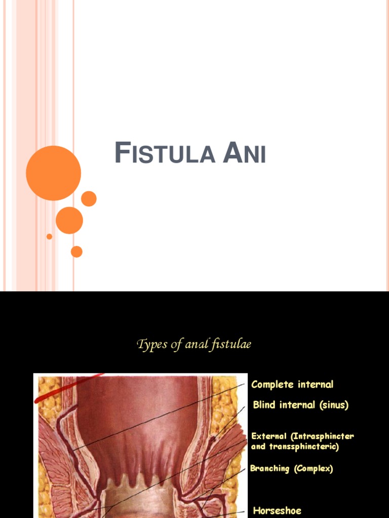 Fistula Ani | PDF