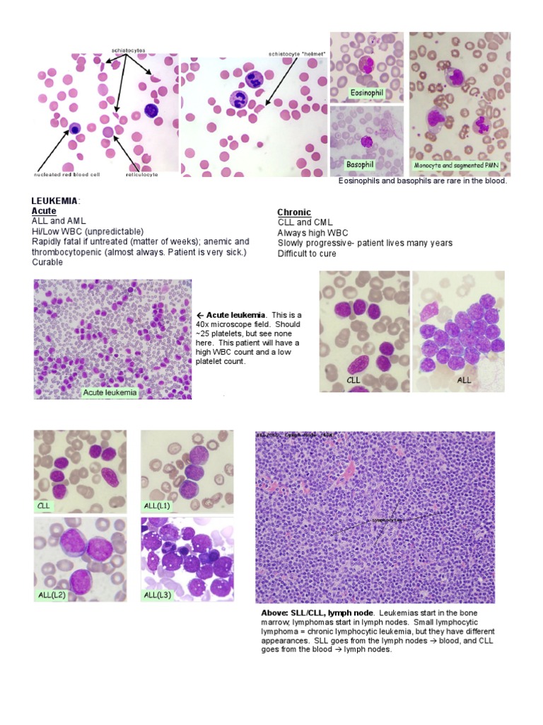 CLL vs CML: Hematologic Insights | PDF | Lymphoma | Bone Marrow