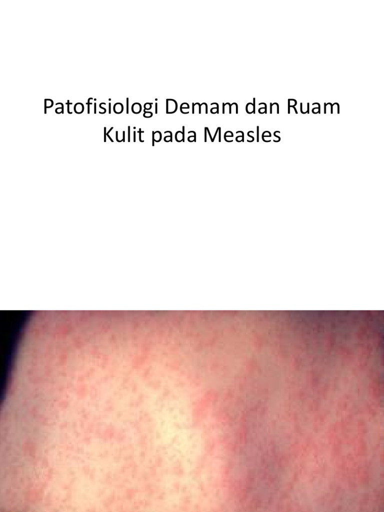 Patofisiologi Demam Dan Ruam Kulit Pada Measles | PDF