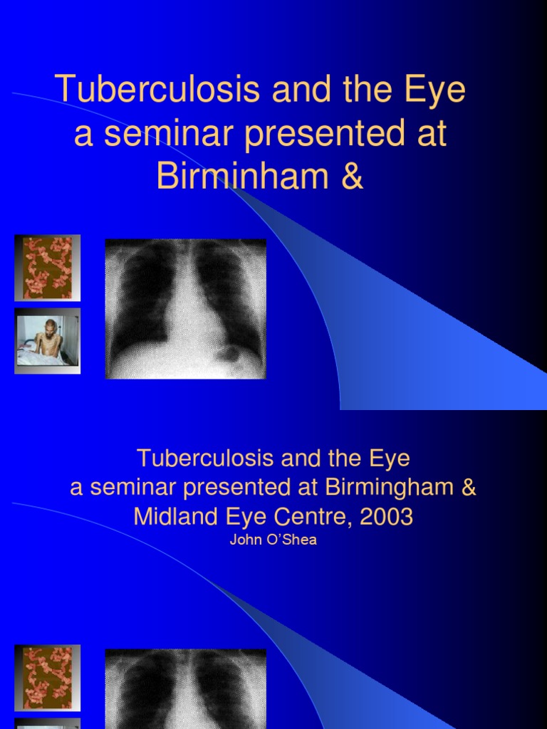 Tuberculosis and The Eye | PDF