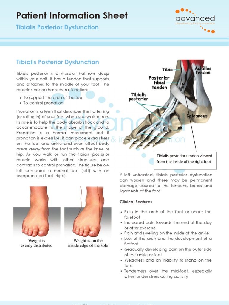 Foot Tendon Tibialis Posterior Dysfunction Acquired Adult Flat-foot ...