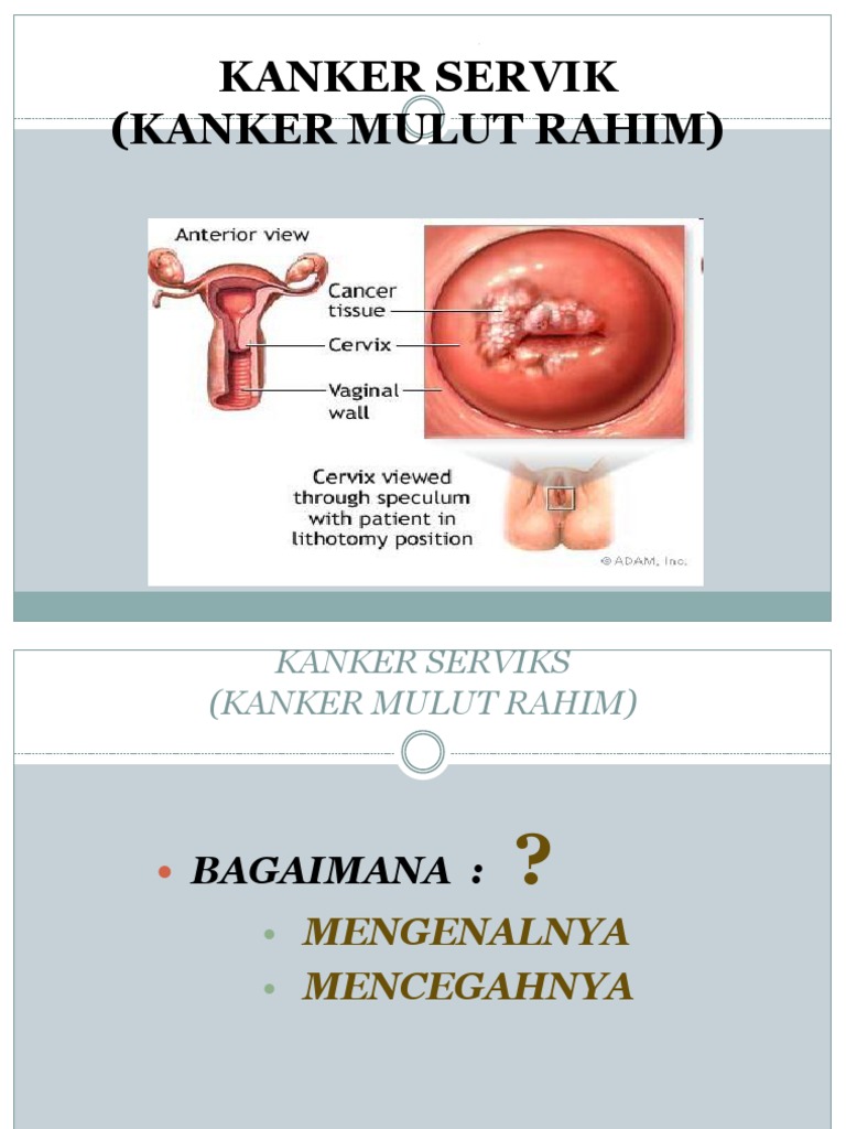 Kanker Serviks | PDF