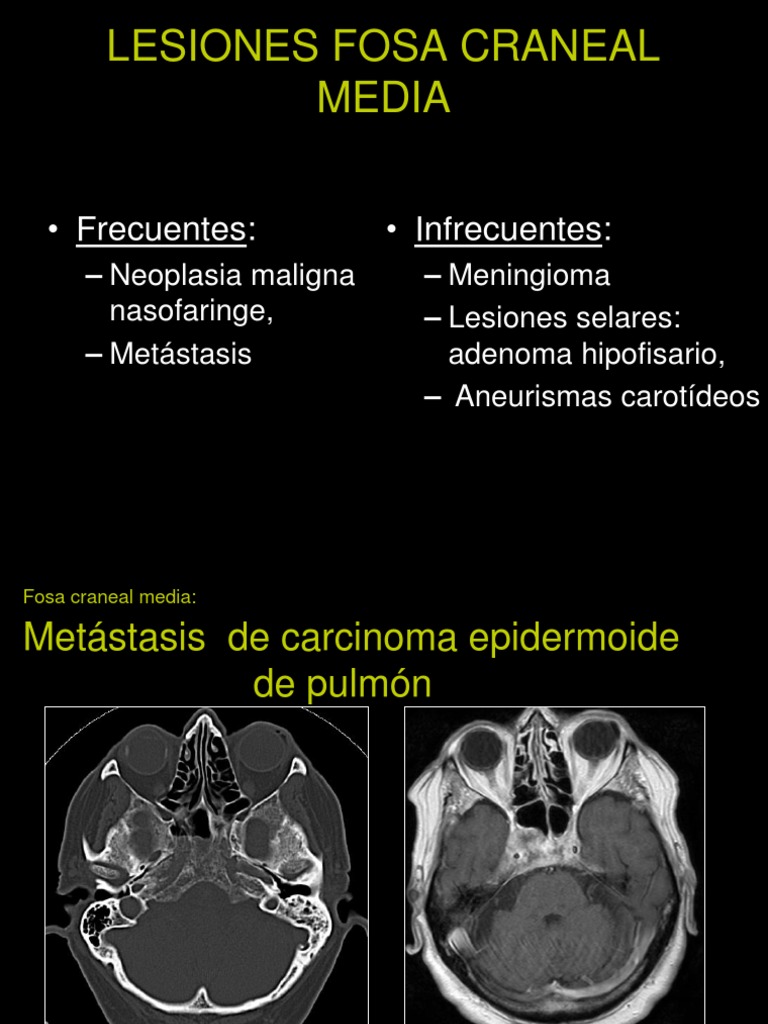 Lesiones de La Fosa Craneal Media | PDF | Anatomia animal | Cabeza y ...