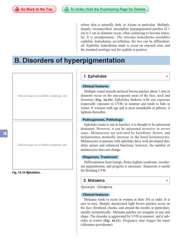 B. Disorders of Hyperpigmentation: 1. Ephelides | PDF | Epidermis ...