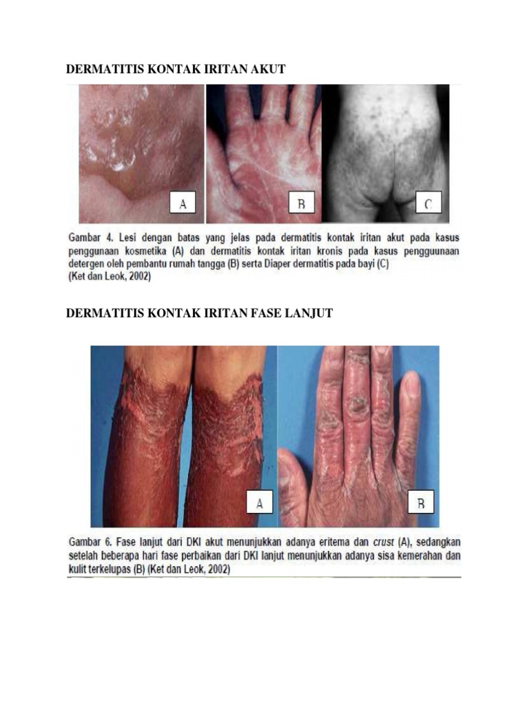 Gambar Dermatitis | PDF