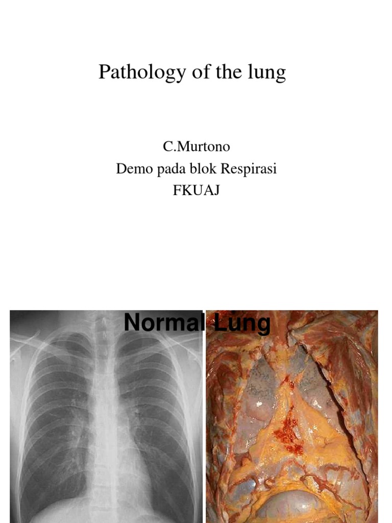 Pathology of The Lung: C.Murtono Demo Pada Blok Respirasi Fkuaj | PDF ...