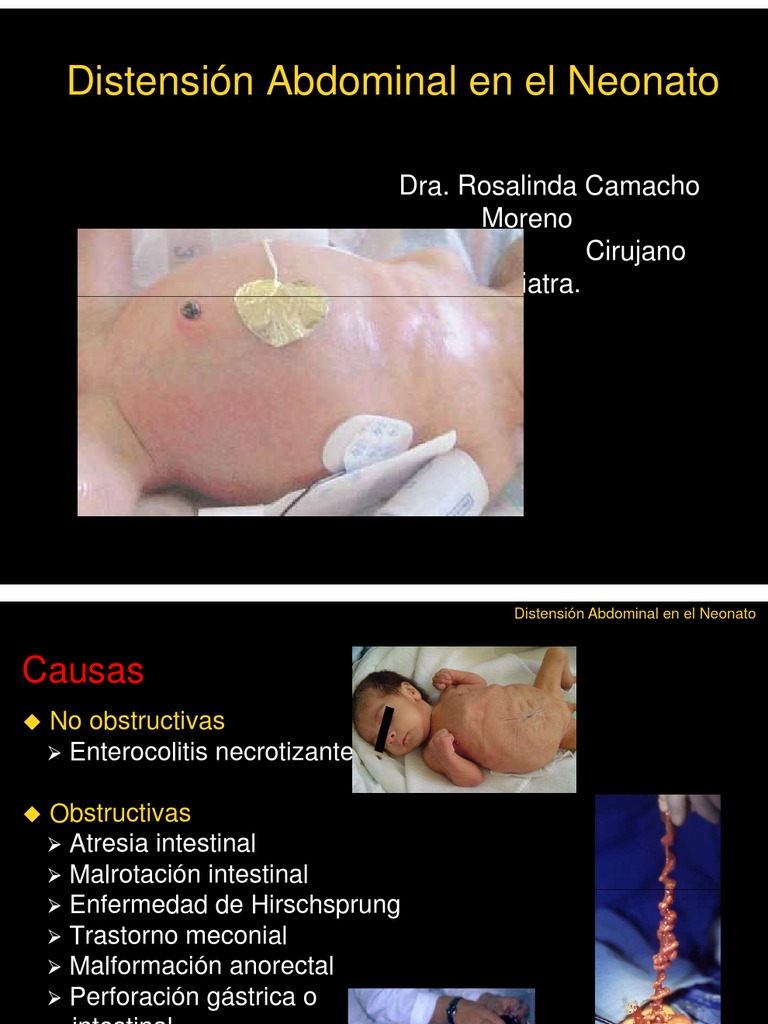 Distensión Abdominal en Neonatos: Causas y Tratamiento | PDF | Abdomen ...