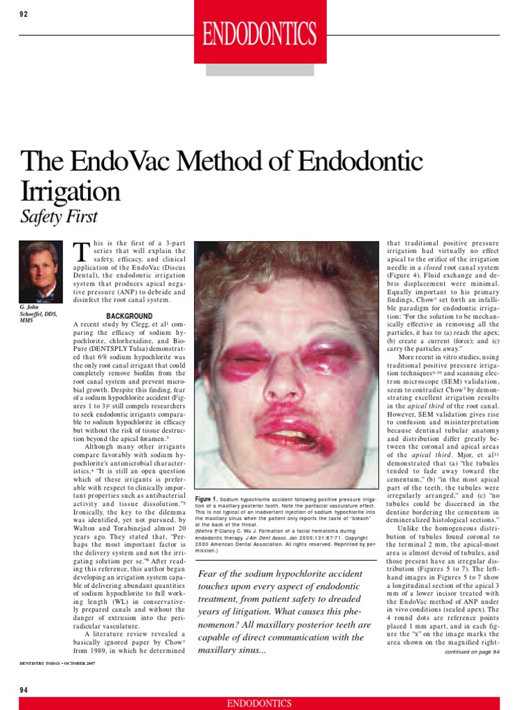 The EndoVac Method of Irrigation | PDF | Chemistry | Wellness