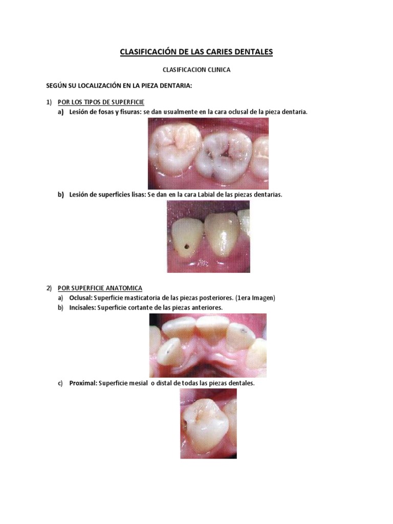CLASIFICACIÓN DE LAS CARIES DENTALES