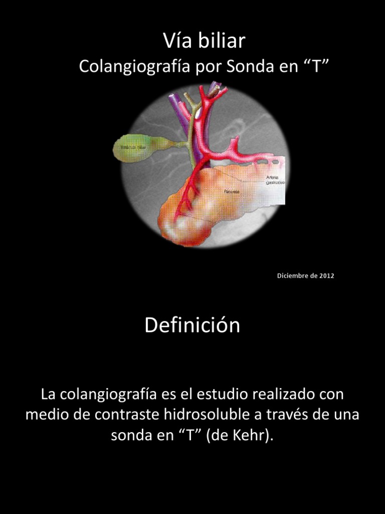Colangio Por T | Vesícula biliar | Hígado | Prueba gratuita de 30 días ...