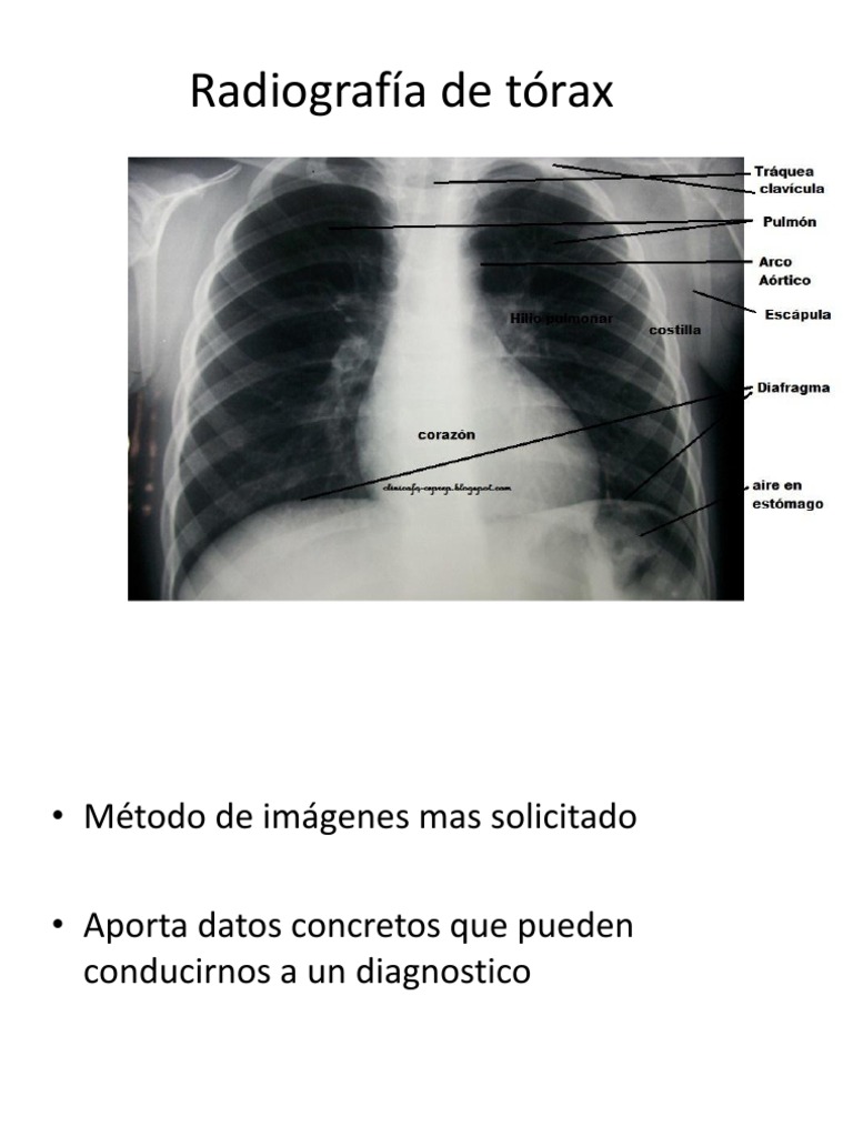 RX Torax Normal | PDF | Pulmón | Tórax