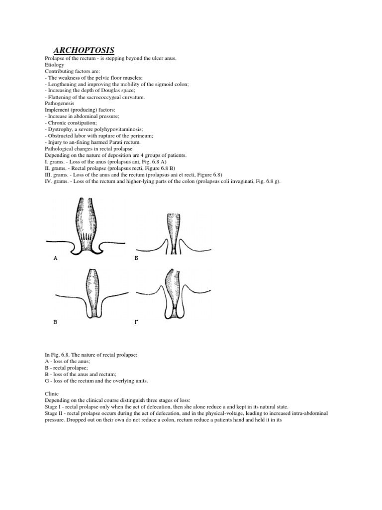 Stages and Treatment of Rectal Prolapse | PDF | Rectum | Digestive System