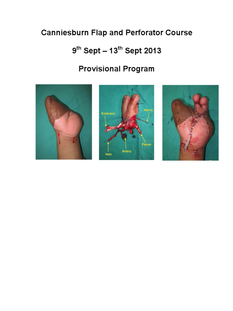 Canniesburn Flap Course Overview | PDF | Plastic Surgery | Surgical ...