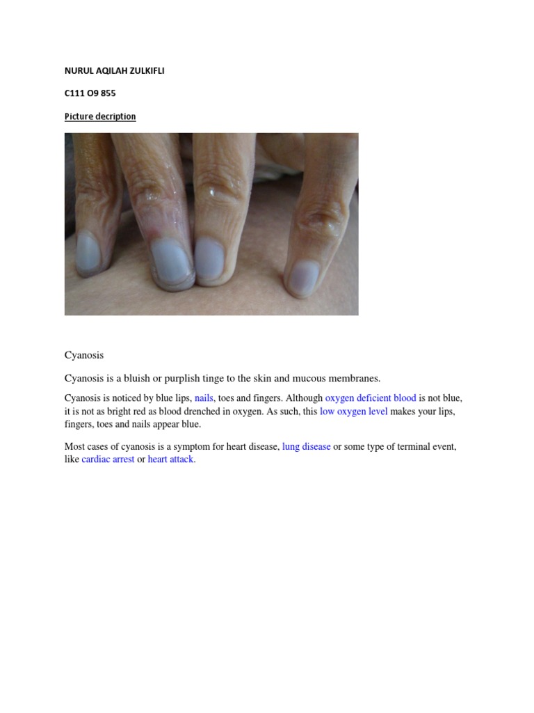 Nurul Aqilah Zulkifli C111 O9 855: Cyanosis Cyanosis Is A Bluish or ...