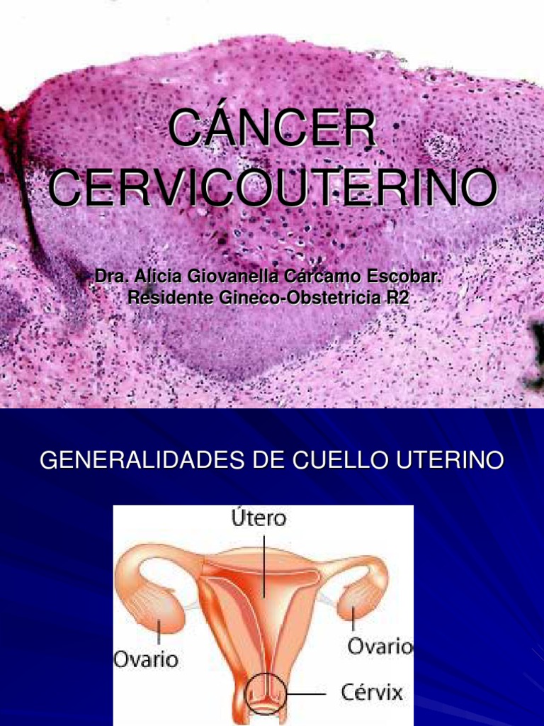 Cáncer de Cuello Uterino: Epidemiología y Tratamiento | PDF | Cáncer de ...