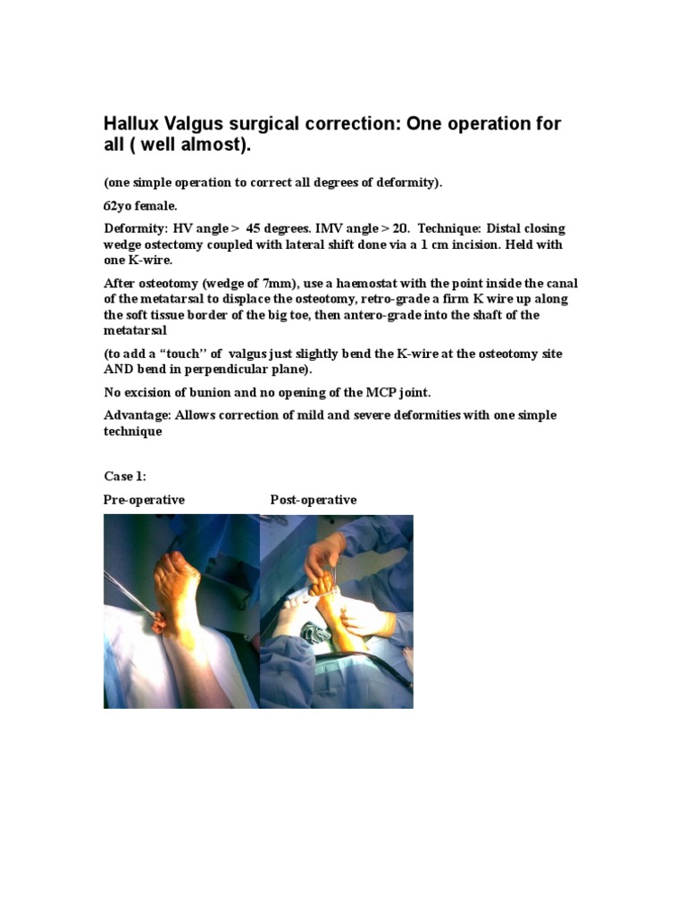 Hallux Valgus Surgery-One Operation For All | PDF