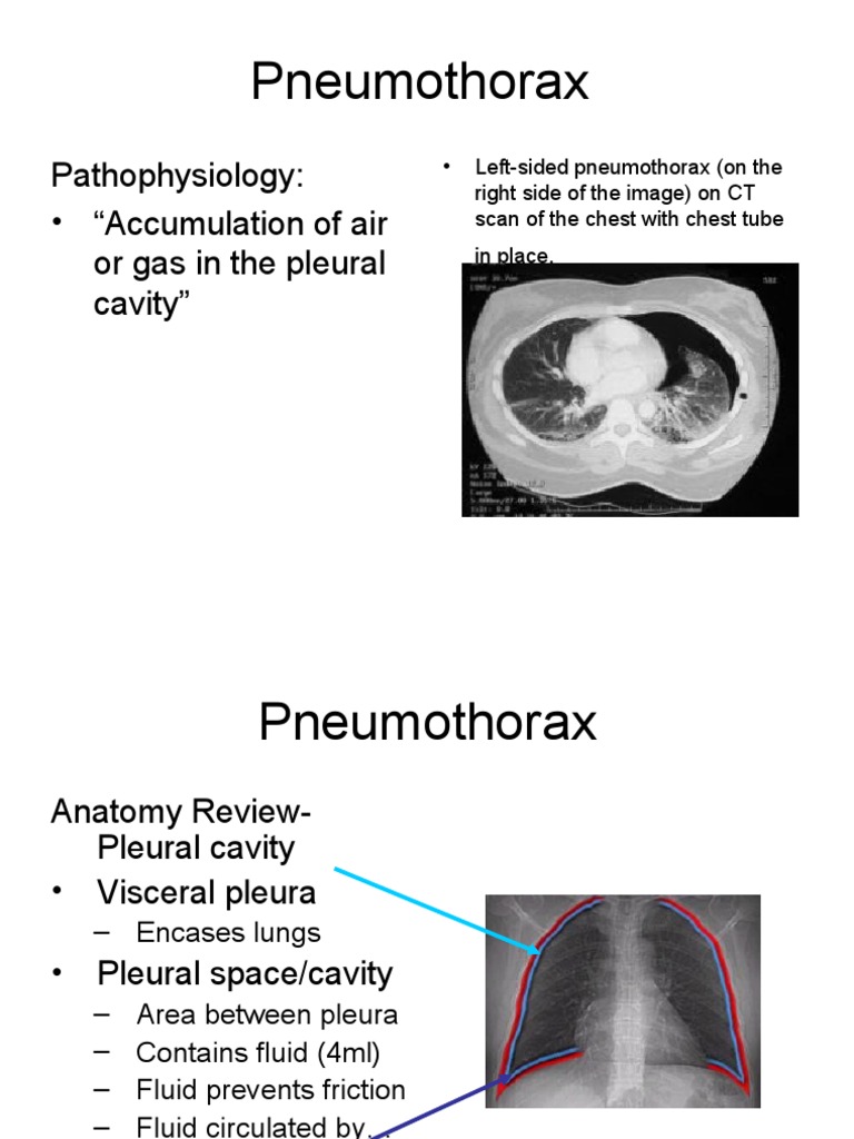 Pneumothorax | PDF | Lung | Pulmonology