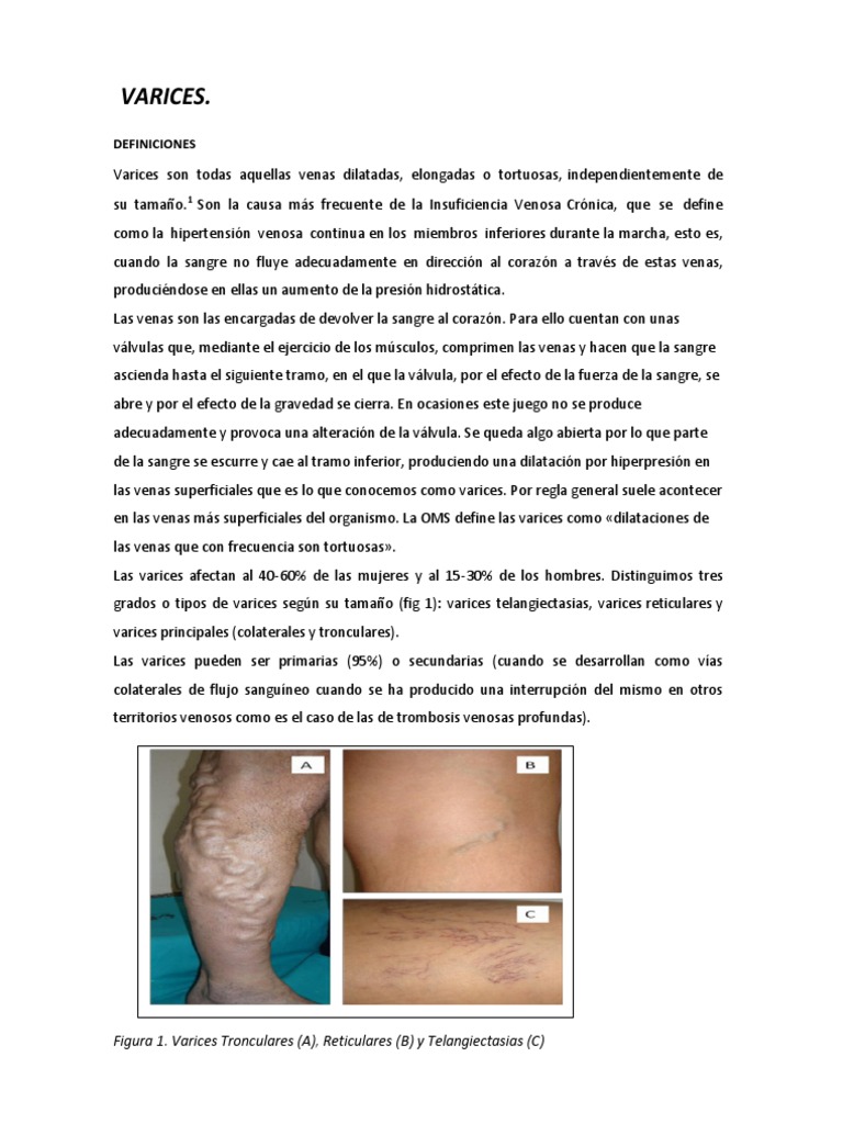 VARICES | PDF | Venas varicosas | Pierna humana
