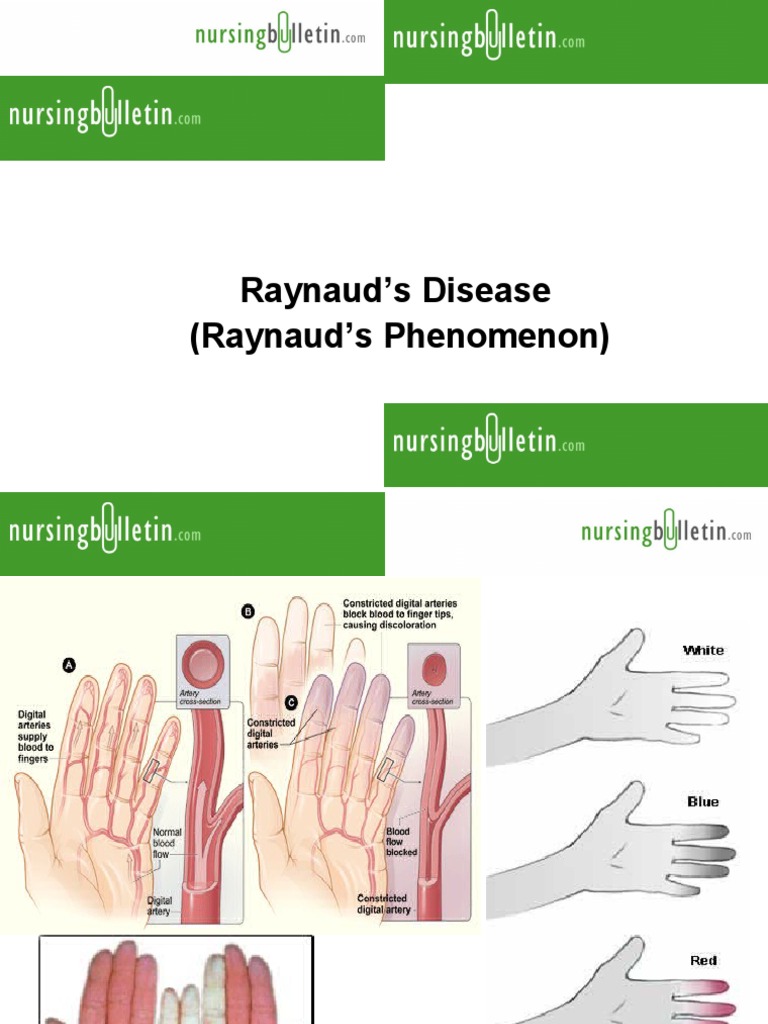 Raynaud's Disease | PDF | Cardiovascular System | Angiology