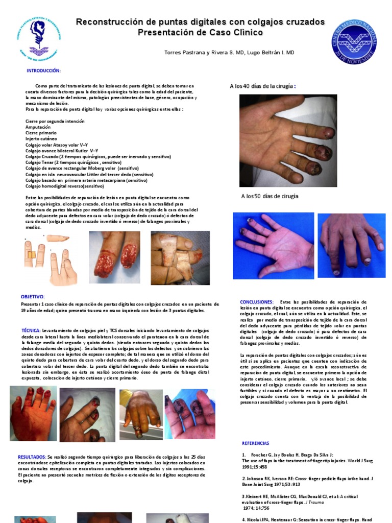 Cartel Cross Finger Flap | PDF | Mano | Medicina