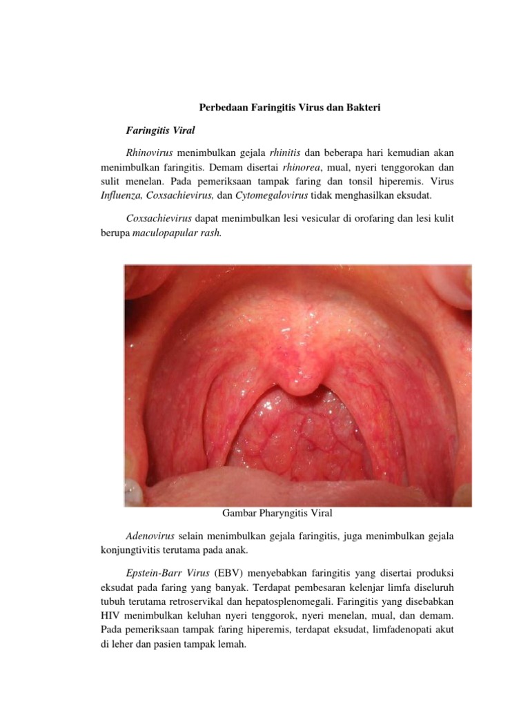 Perbedaan Faringitis Virus Dan Bakteri | PDF