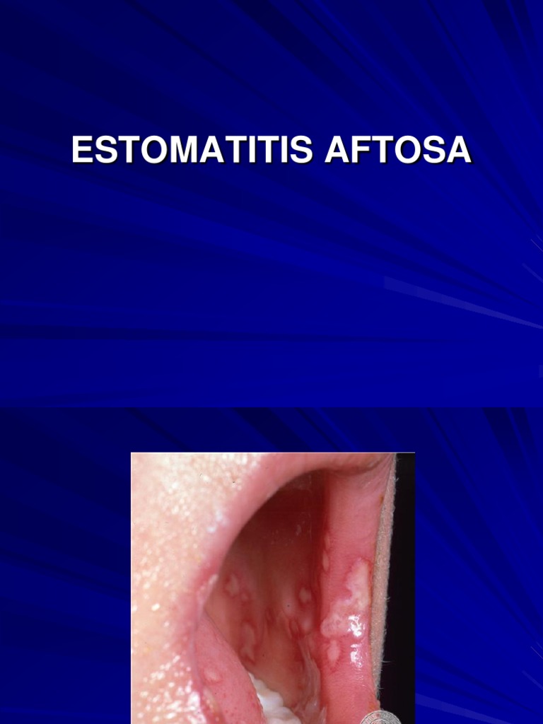 Estomatitis Aftosa Recurrente | PDF | Ciencias de la Salud ...