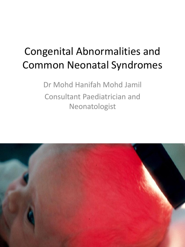 Common Neonatal Dysmorphic:Syndromes | PDF | Congenital Disorder | Down ...