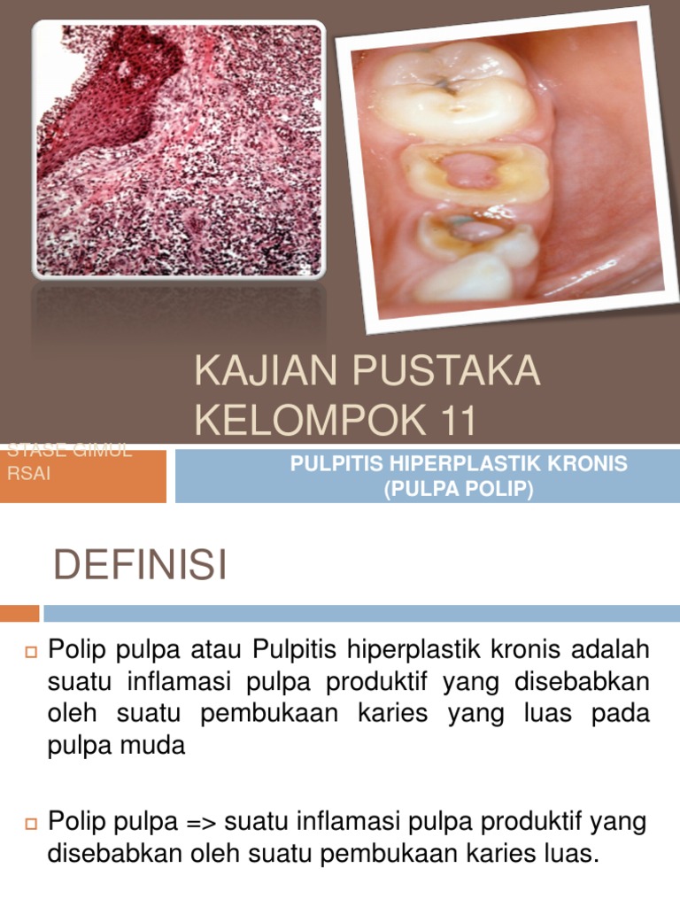 PULPITIS HIPERPLASTIK KRONIS: PENYAKIT INFLAMASI PULPA YANG DAPAT ...