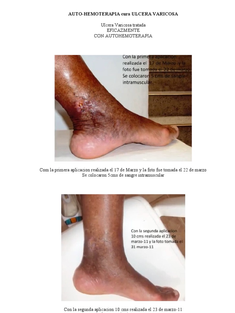 Autohemoterapia Cura Ulcera Varicosa | PDF