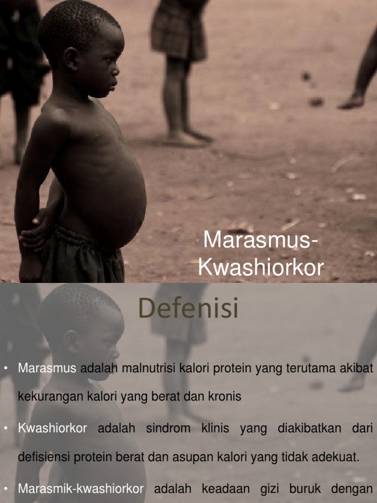 Marasmus Kwashiorkor | PDF