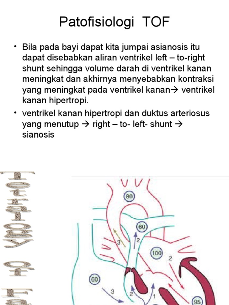 Patofisiologi TOF | PDF