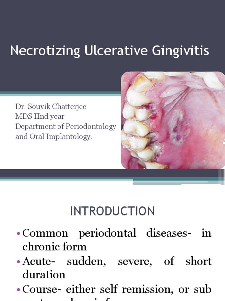 Necrotizing Ulcerative Gingivitis | PDF | Health Sciences | Clinical Medicine