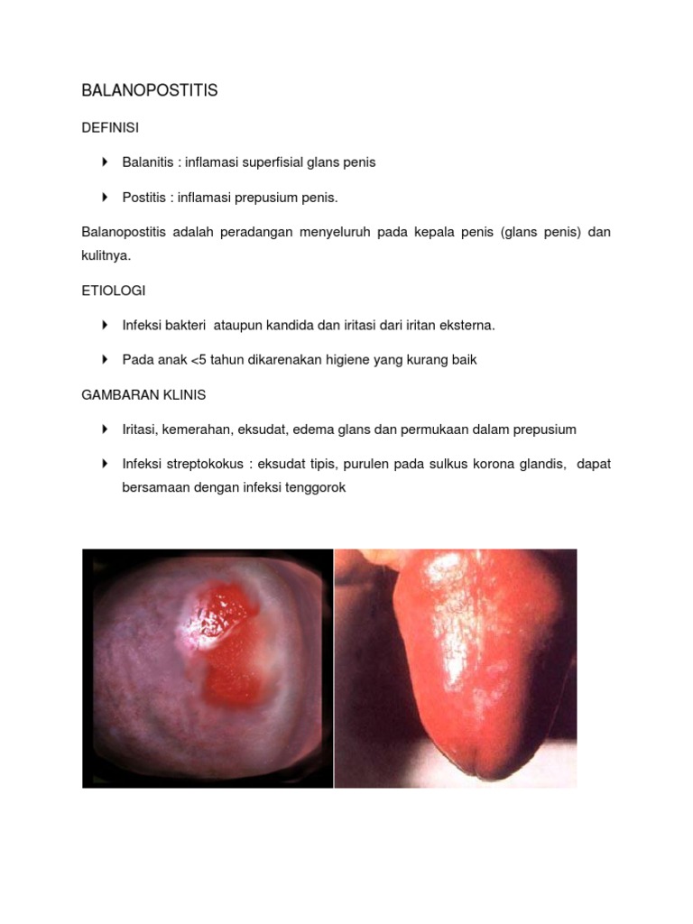 Balanopostitis Dan Adesi | PDF