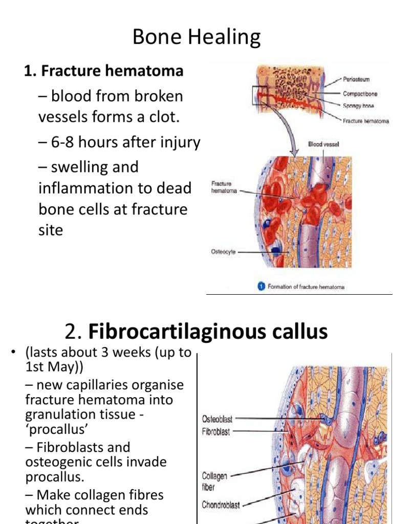 Stage of Fracture Healing | PDF