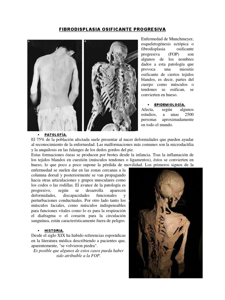 Enfermedad de Munchmeyer | PDF | Enfermedades y trastornos | Medicina
