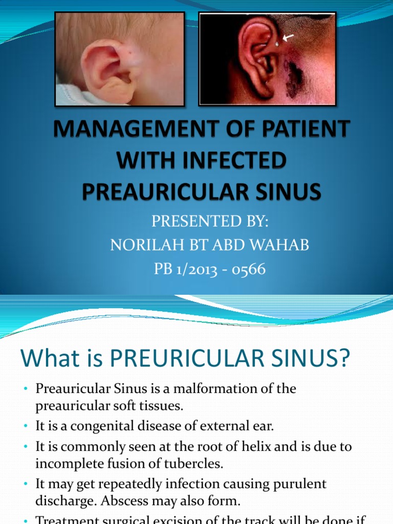 Preauricular Sinus | Wound | Surgery