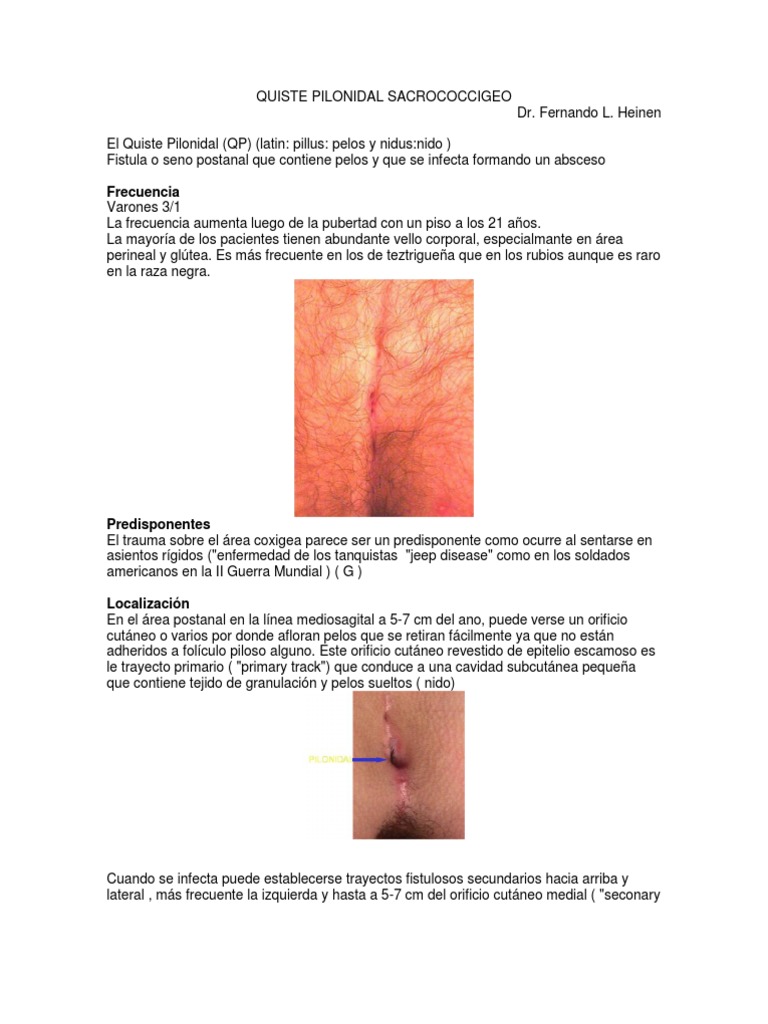 Quiste Pilonidal: Causas y Tratamiento | PDF | Piel | Herida