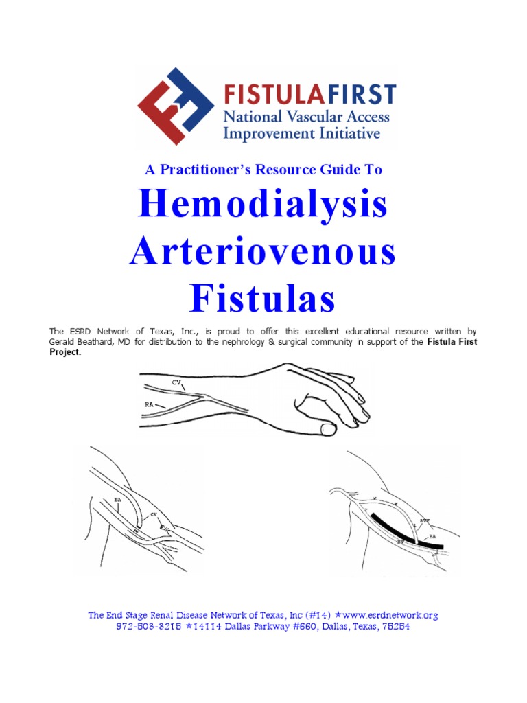 Arteriovenous Fistulas | Hemodialysis | Vein