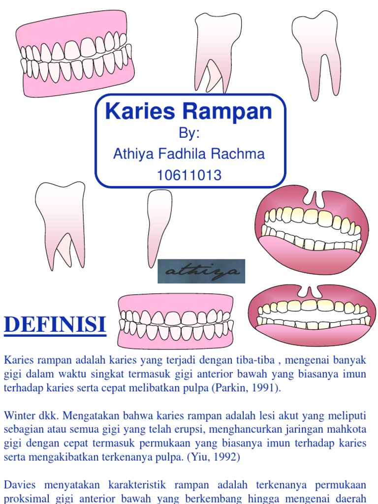 Rampan Karies | PDF