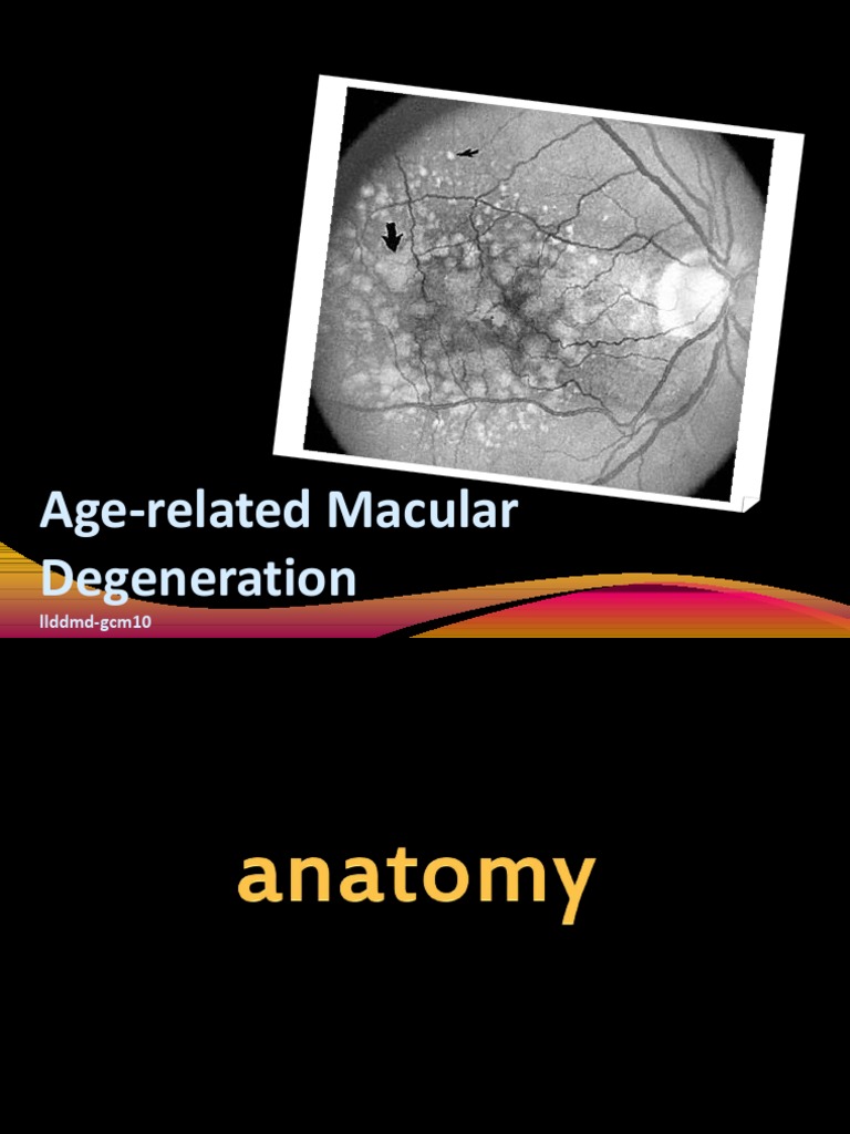 Age Related Macular Degeneration Presentation 1 | PDF | Visual System ...