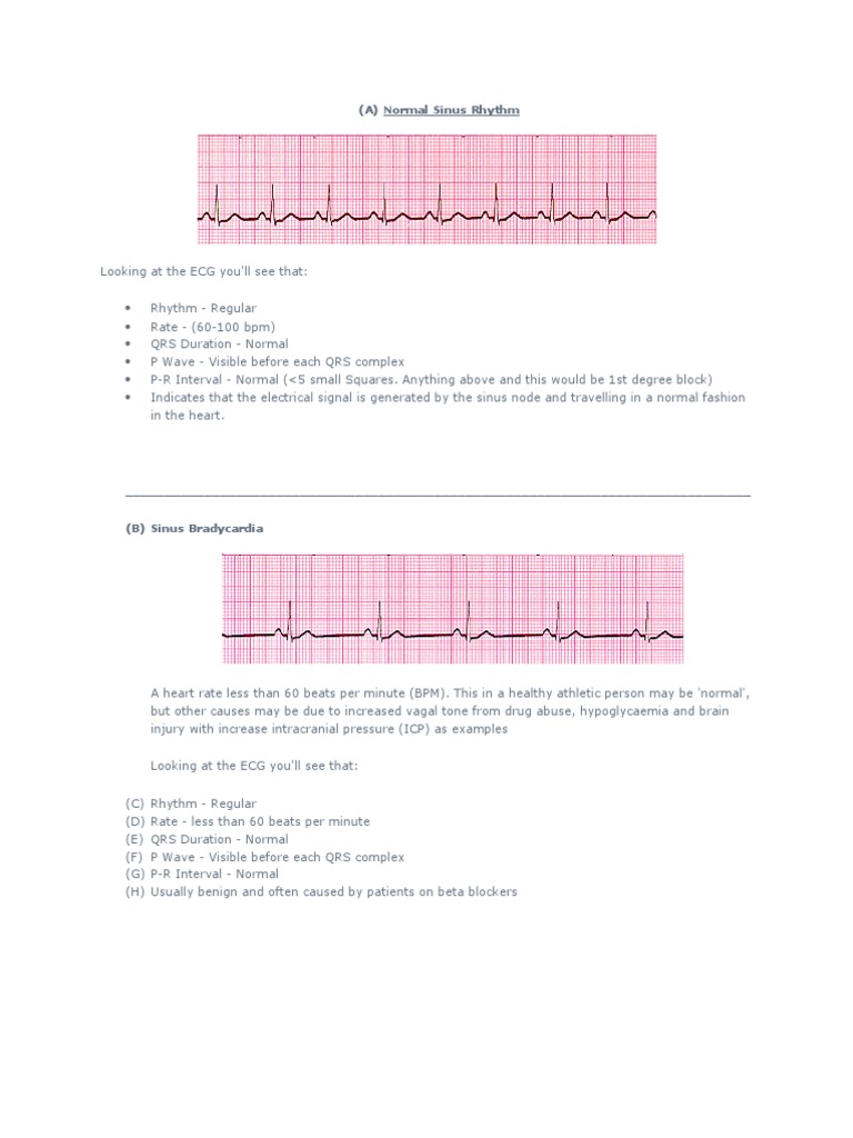 Normal Sinus Rhythm | Download Free PDF | Electrocardiography | Cardiac ...
