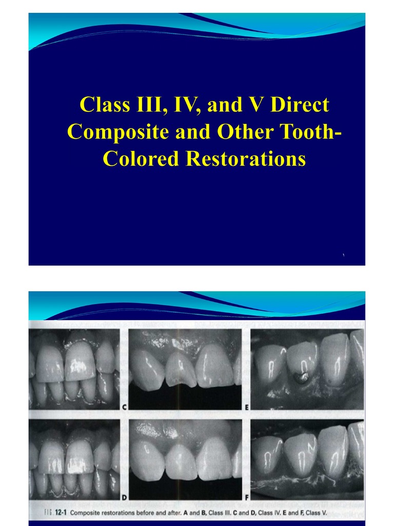 Class III Composite Restoration Techniques | PDF | Tooth Enamel | Tooth